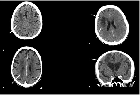 White Matter Hyperintensity and Vascular Disease from Biological Basis to Clinical Significance